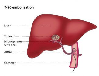 Radioembolization (Y90) - West Cancer Center